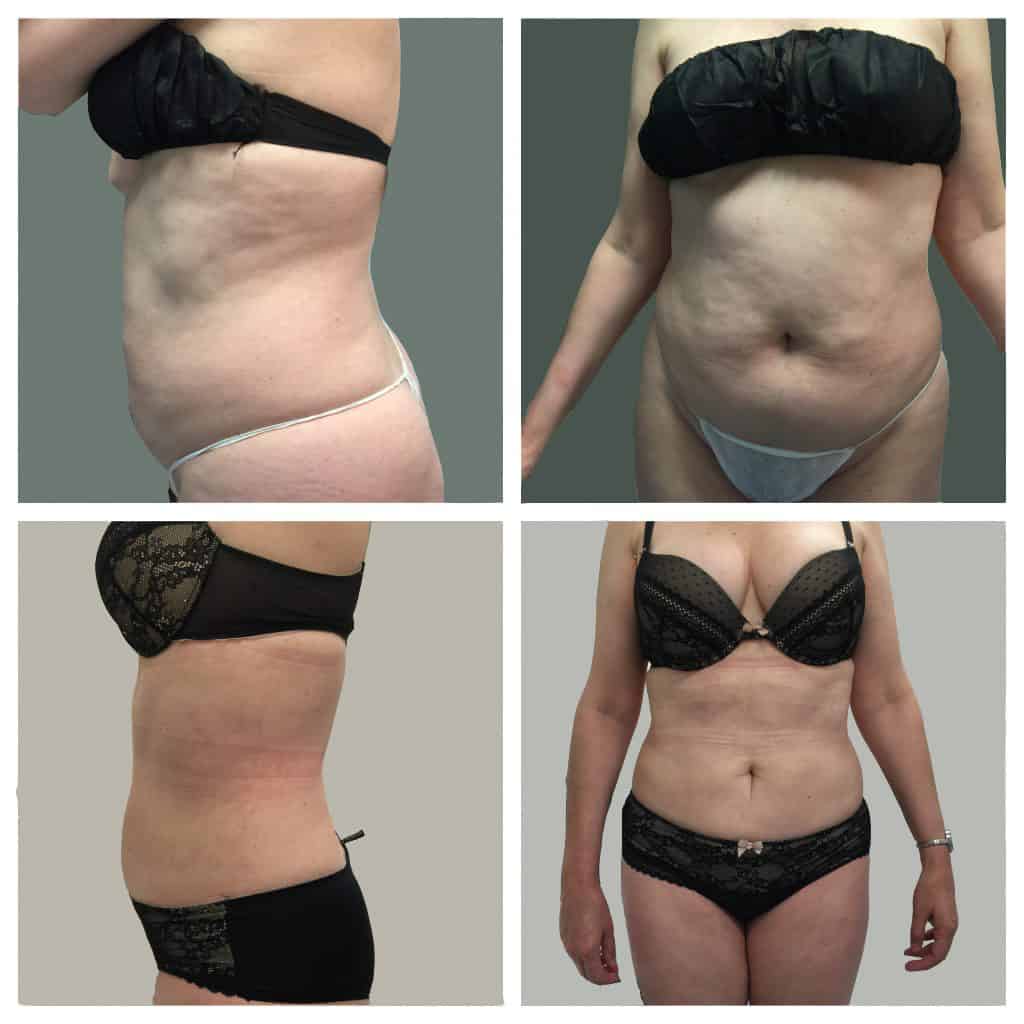 liposuction mansfield